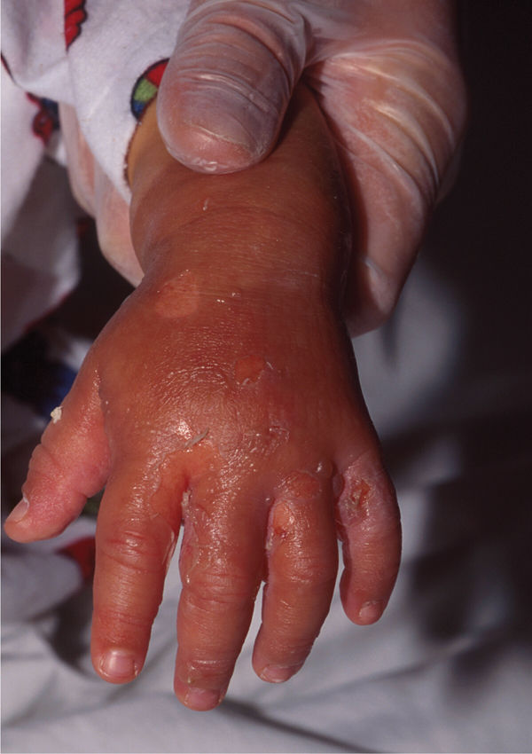 Burn Wound Management Plastic Surgery Key Burn Wound Management Plastic Surgery Key
