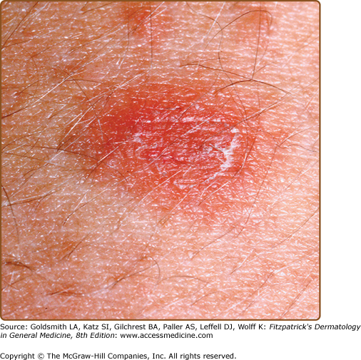 Pityriasis Rosea Plastic Surgery Key Pityriasis Rosea Plastic Surgery Key
