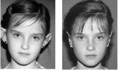 Otoplasty Surgery For Protruding Ears Plastic Surgery Key