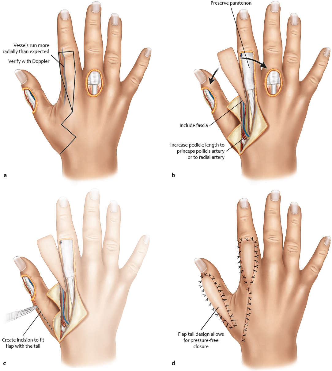 First Dorsal Metacarpal Artery Flap Kite Flap Plastic Surgery Key