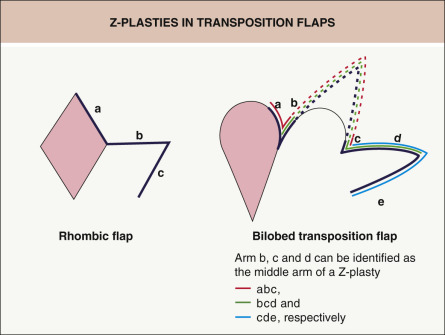 Transposition Flap