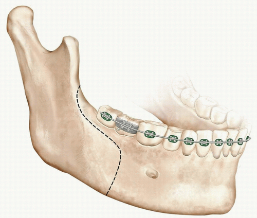 Mandibular Setback Plastic Surgery Key