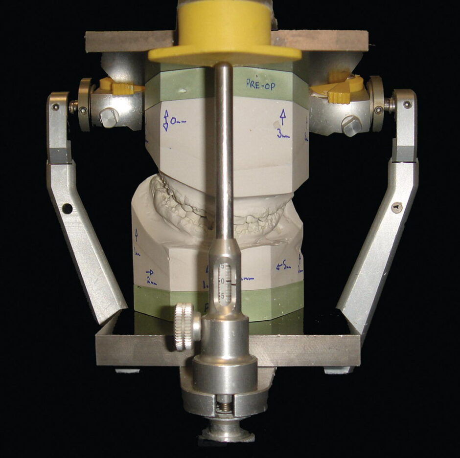 Mentolabial (Labiomental) Fold - Plastic Surgery KeyPlastic Surgery Key