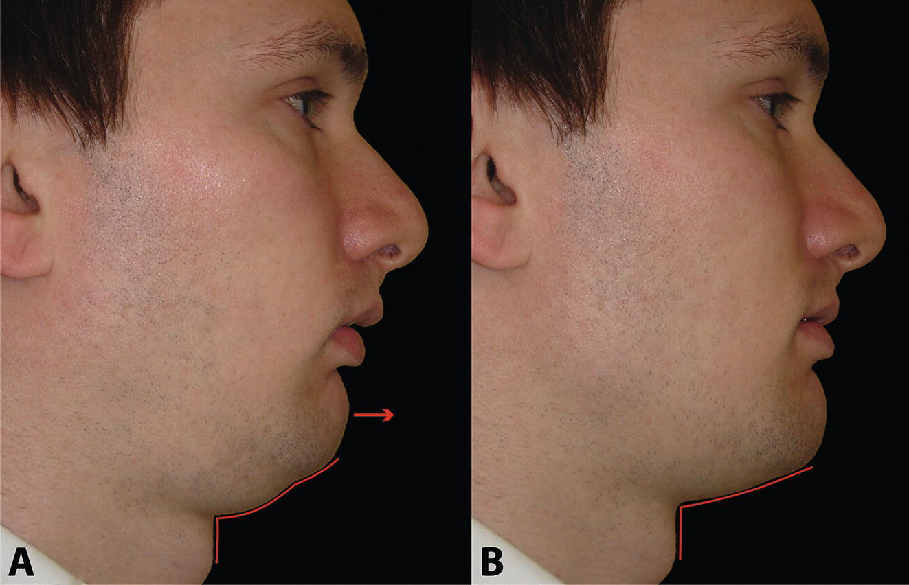 Submental‐Cervical Region | Plastic Surgery Key